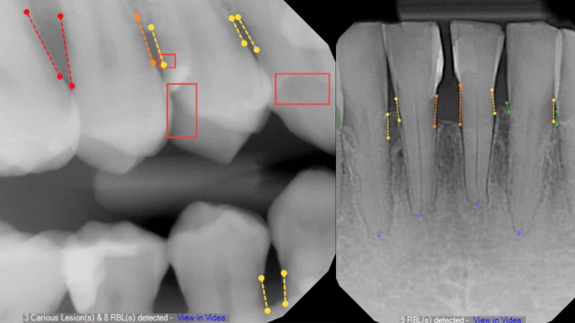 Revolutionizing Dentistry with Artificial Intelligence (AI) to Detect ...